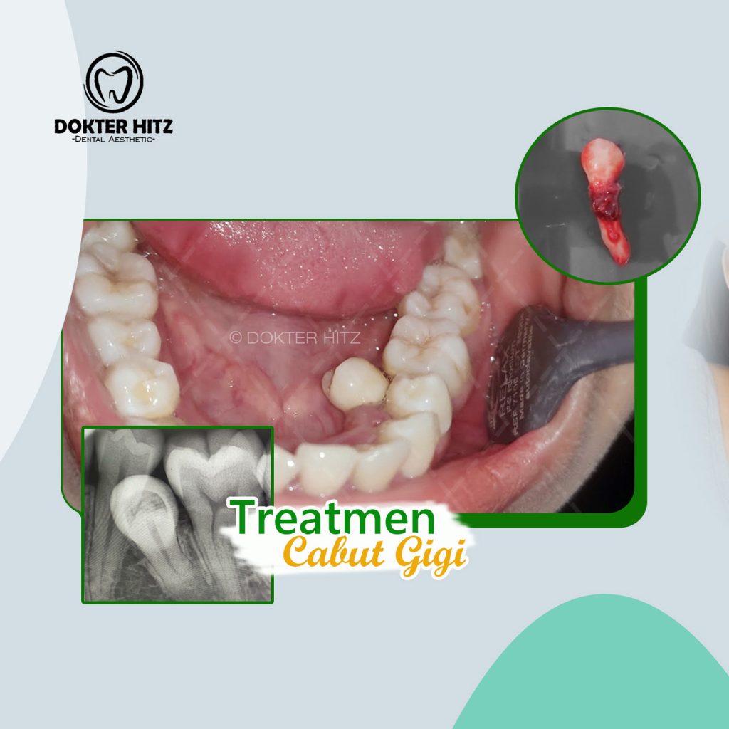 Cabut Gigi - Dokter Hitz