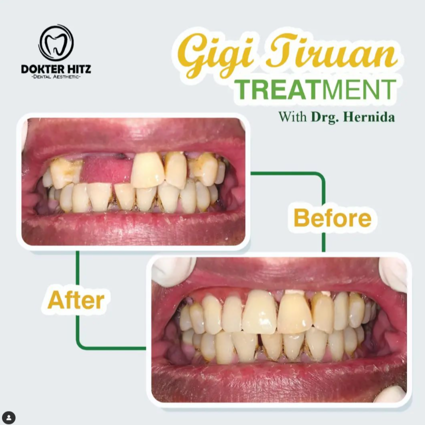 Gigi Tiruan - Dokter Hitz